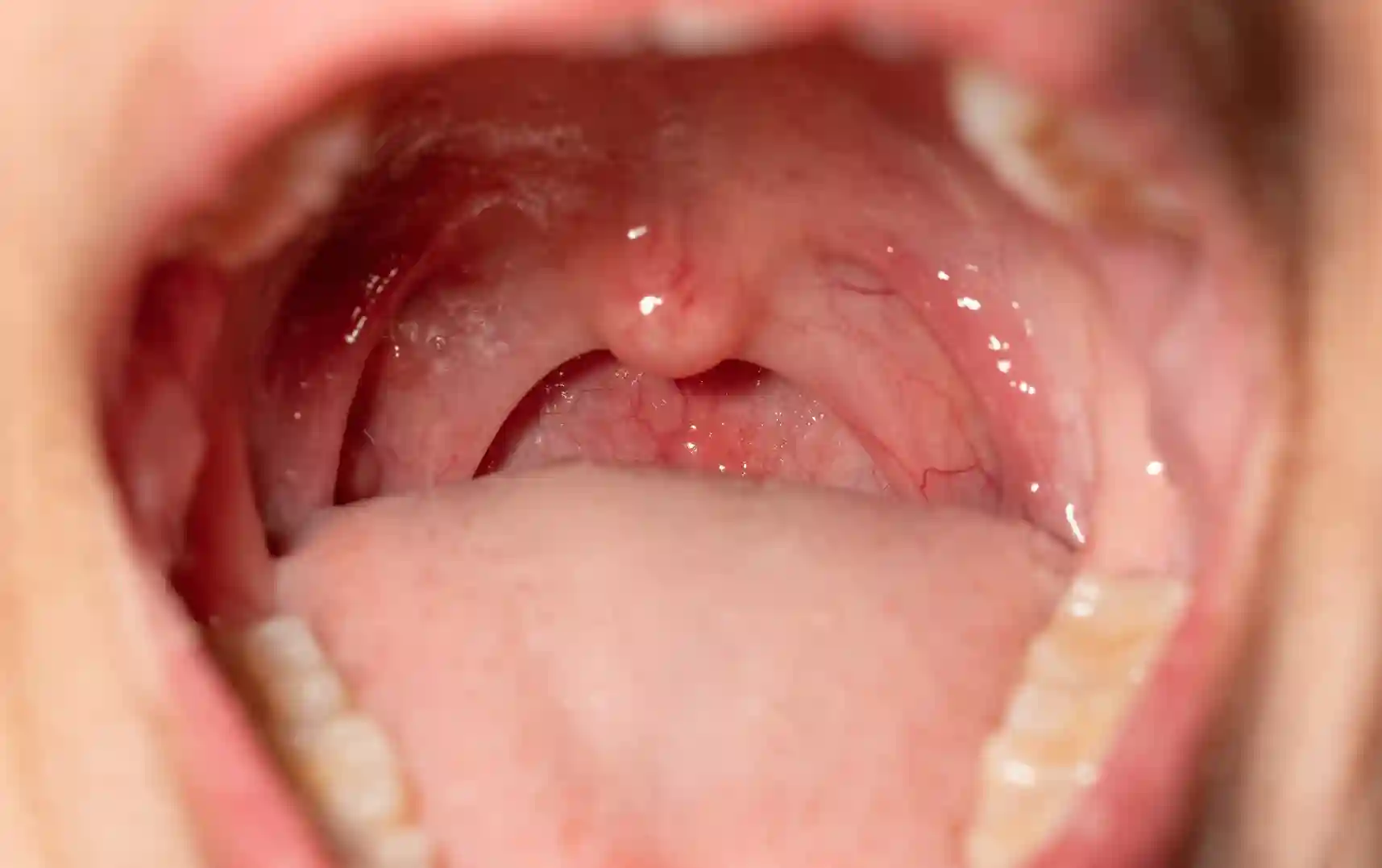 difference between strep throat and tonsillitis